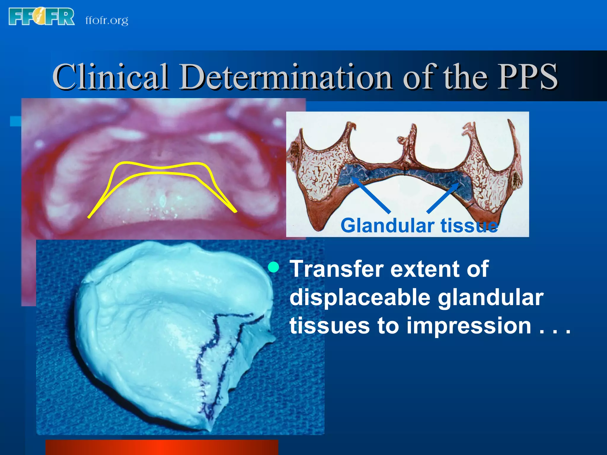 26.posterior palatal seal | PPT