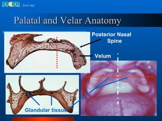 26.posterior palatal seal | PPT