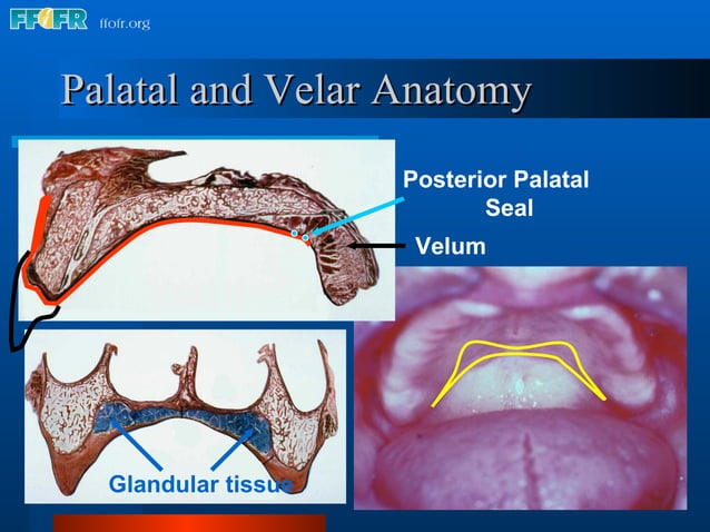 26.posterior palatal seal | PPT