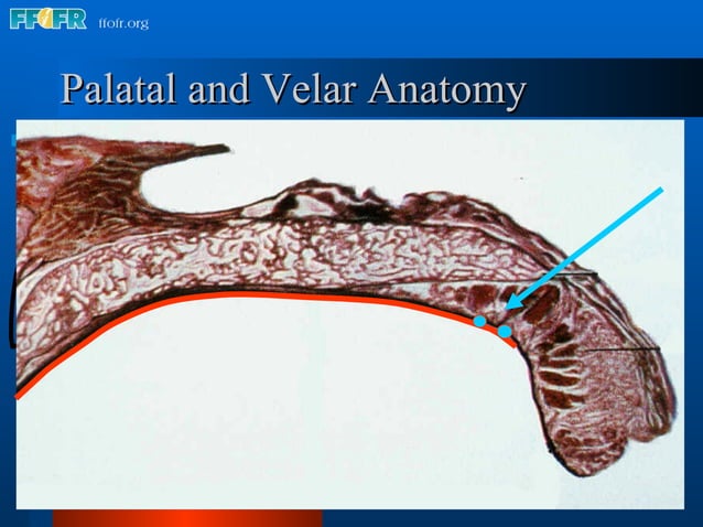 26.posterior palatal seal | PPT