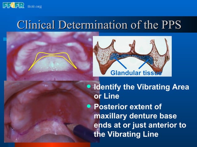 26.posterior palatal seal | PPT