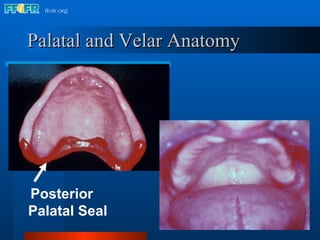 Posterior Palatal Seal Area Anatomy