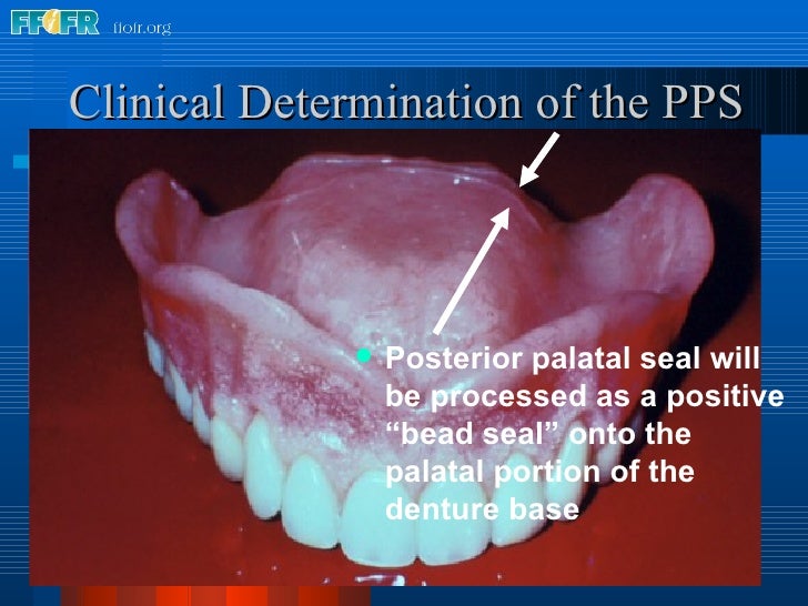 26.posterior palatal seal