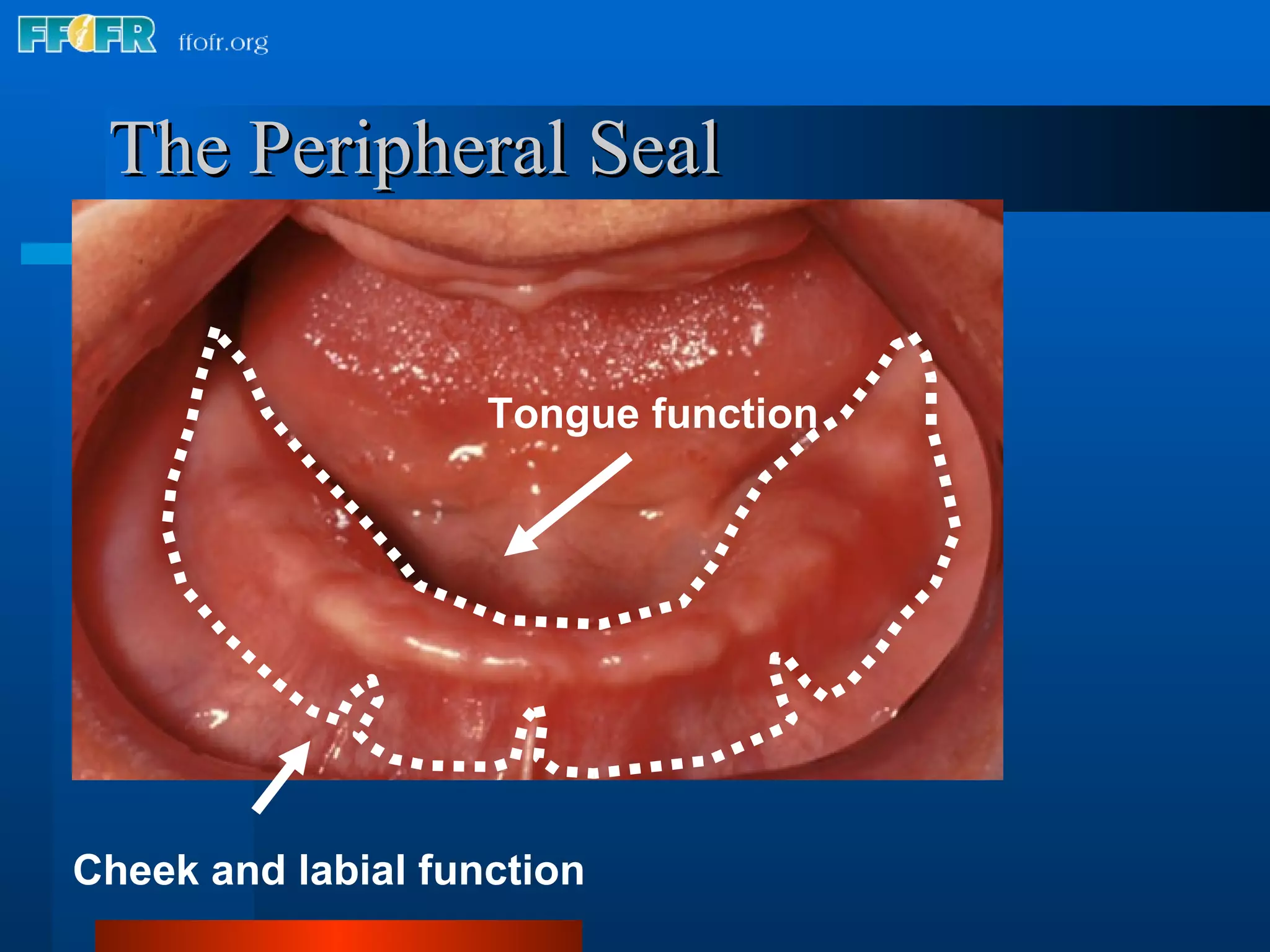26.posterior palatal seal | PPT