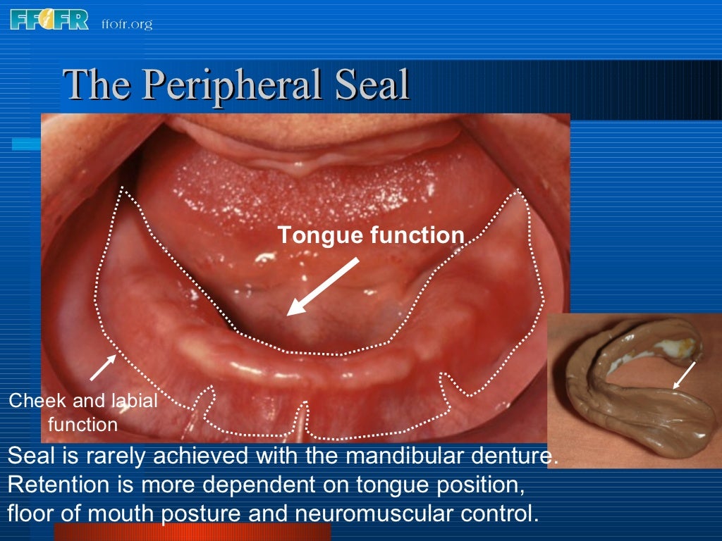 26 posterior Palatal Seal 26-posterior-palatal-seal