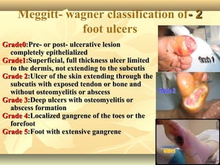 ueda2012 predictors of diabetic foot ulcer-d.walaa | PPT