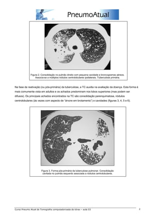 Tc tórax: tuberculose pulmonar | PDF