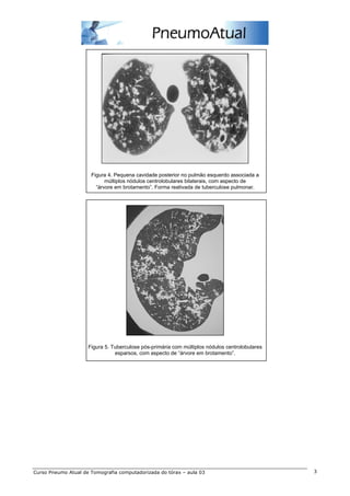 Tc tórax: tuberculose pulmonar | PDF
