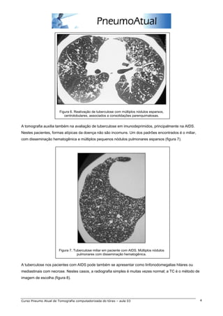 Tc tórax: tuberculose pulmonar | PDF