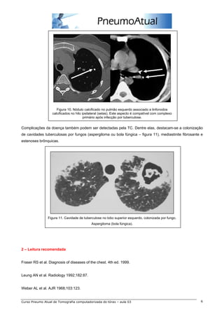 Tc tórax: tuberculose pulmonar | PDF