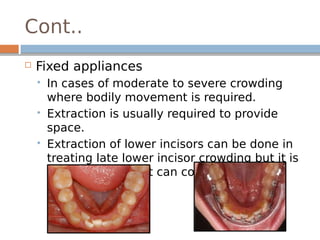 262054548-Late-Lower-Incisor-Crowding.pdf