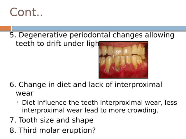 262054548-Late-Lower-Incisor-Crowding.pdf