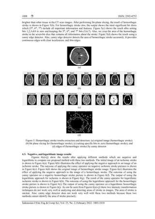 Analyzing and detecting hemorrhagic and ischemic strokebased on bit ...