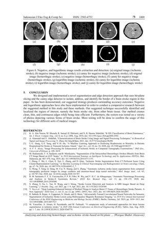 Analyzing and detecting hemorrhagic and ischemic strokebased on bit plane slicing and edge ...