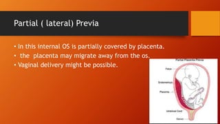 Antepartum hemorrhage causes risk factors | PPTX