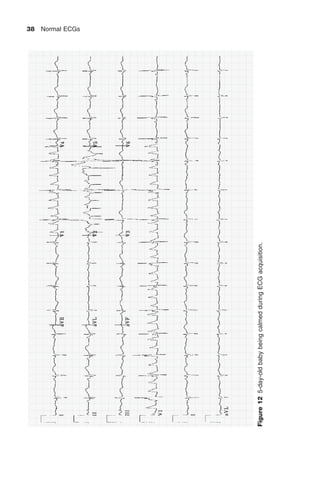 Pediatric Ecg Interpretation An Illustrative Guide Barbara J Deal | PDF