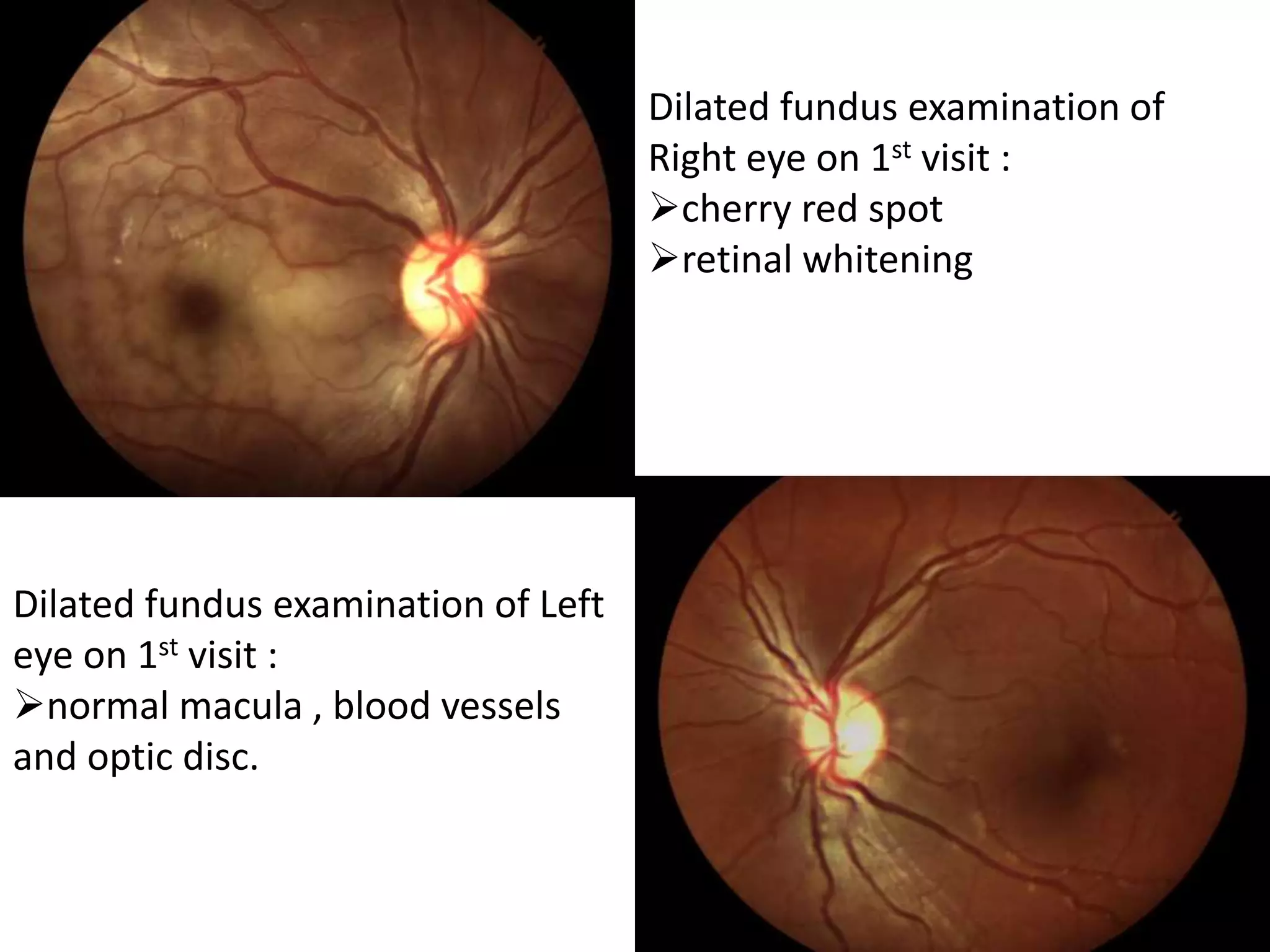 Recovery Of Vision In A Young Patient With Central Retinal Artery ...