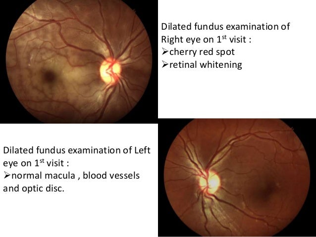 Recovery Of Vision In A Young Patient With Central Retinal
