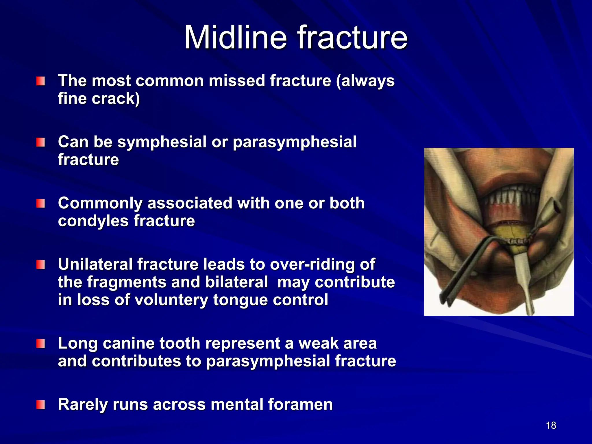 268307418-Management-of-Mandibular-fractures-ppt.ppt