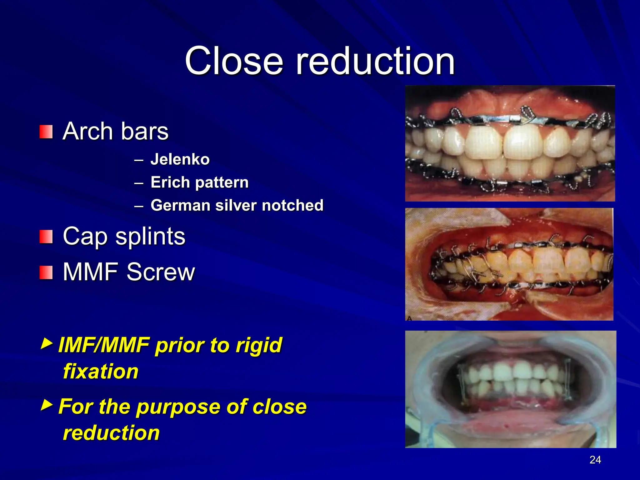 268307418-Management-of-Mandibular-fractures-ppt.ppt