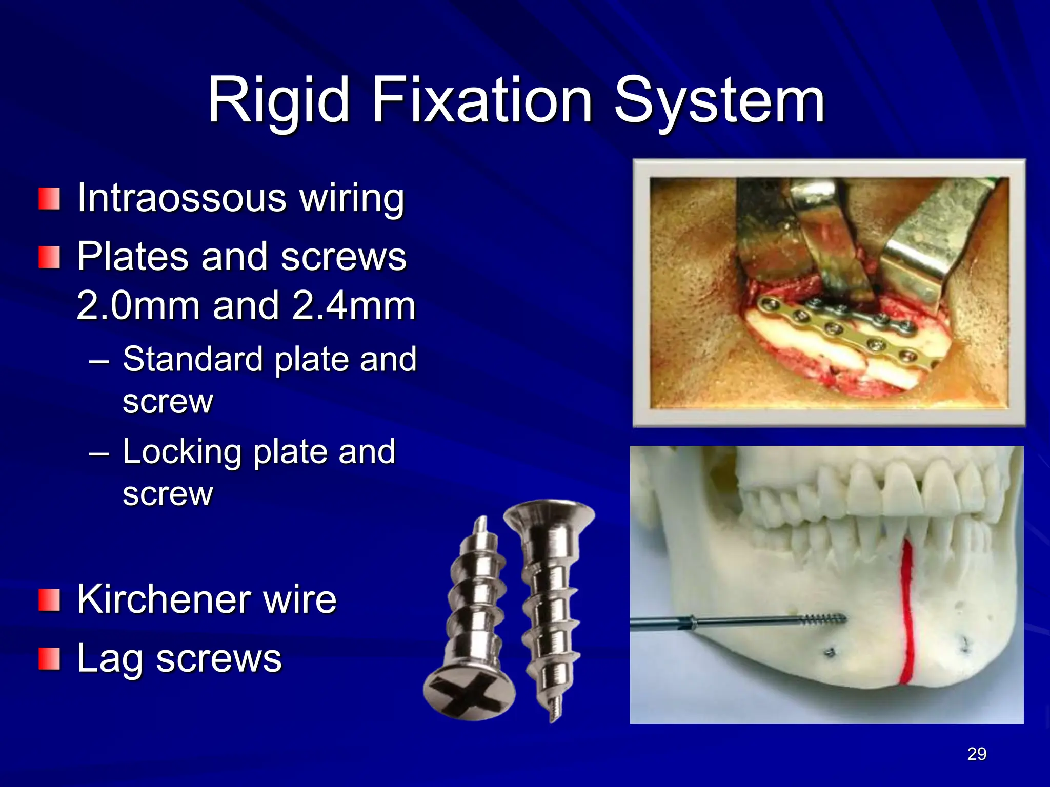 268307418-Management-of-Mandibular-fractures-ppt.ppt