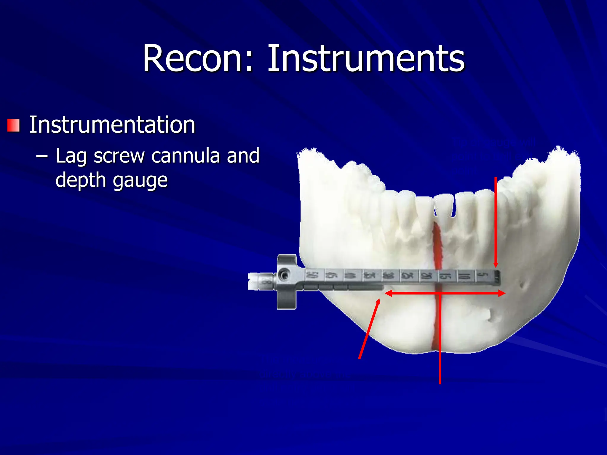 268307418-Management-of-Mandibular-fractures-ppt.ppt