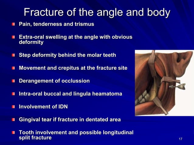 268307418-Management-of-Mandibular-fractures-ppt.ppt