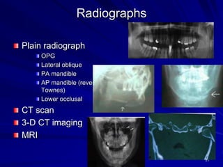 268307418-Management-of-Mandibular-fractures-ppt.ppt