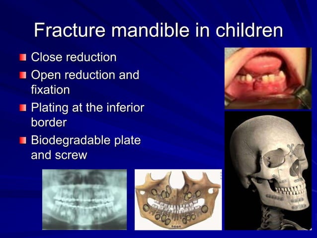 268307418-Management-of-Mandibular-fractures-ppt.ppt