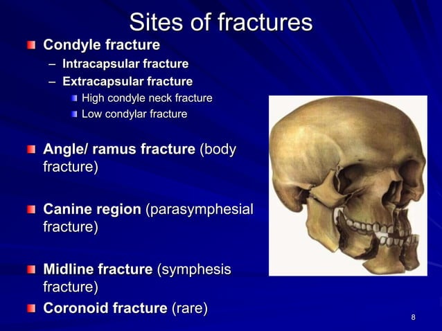 268307418-Management-of-Mandibular-fractures-ppt.ppt