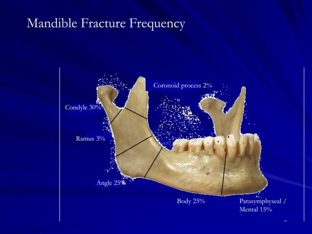 268307418-Management-of-Mandibular-fractures-ppt.ppt