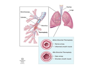 Respiratory diseases : Asthma and bronchitis | PPT