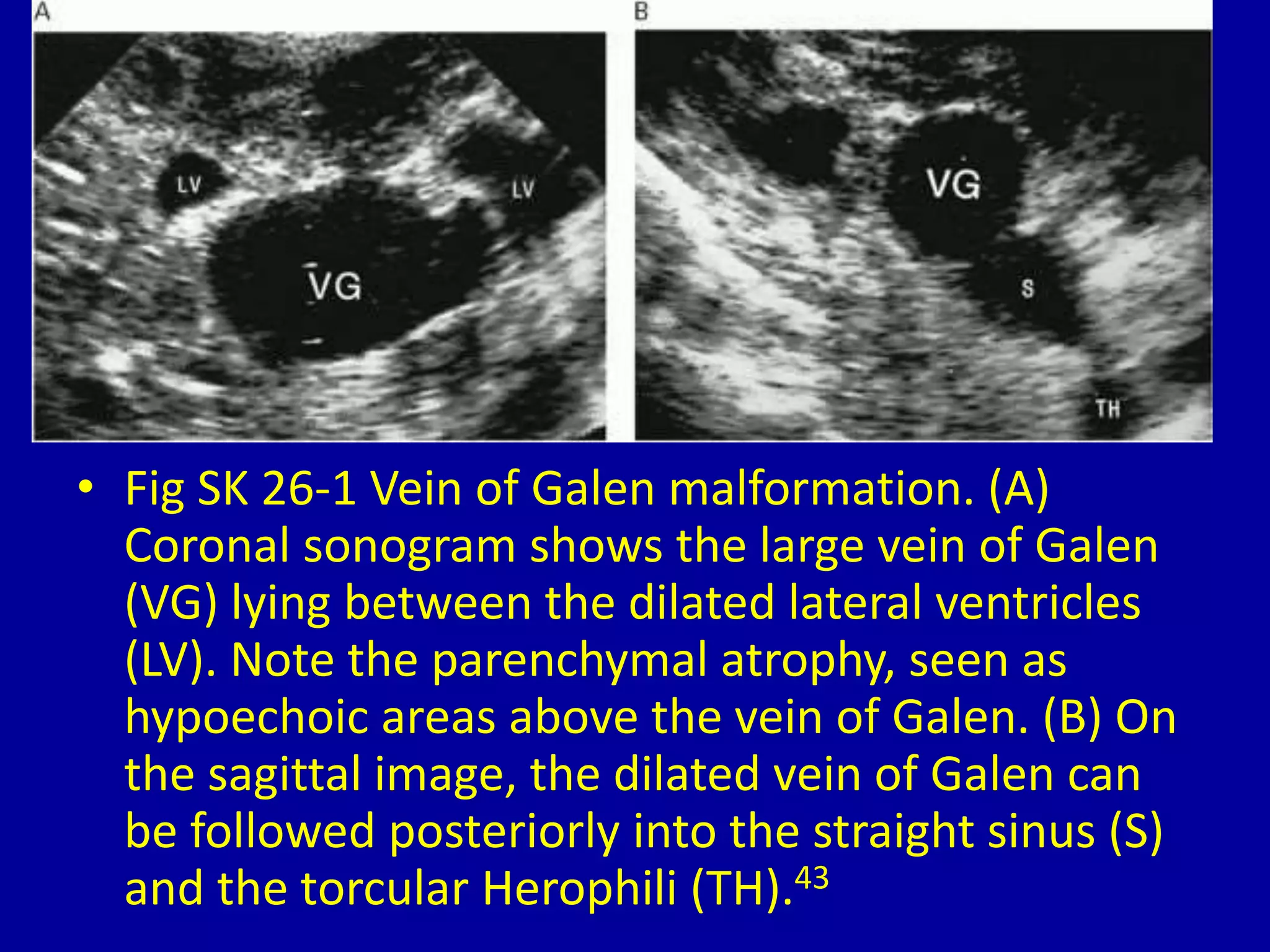 26 midline congenital anomalies on ultrasonography | PPTX