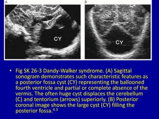 26 midline congenital anomalies on ultrasonography | PPTX