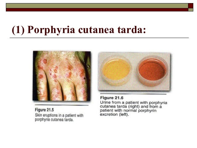 26 porphyria