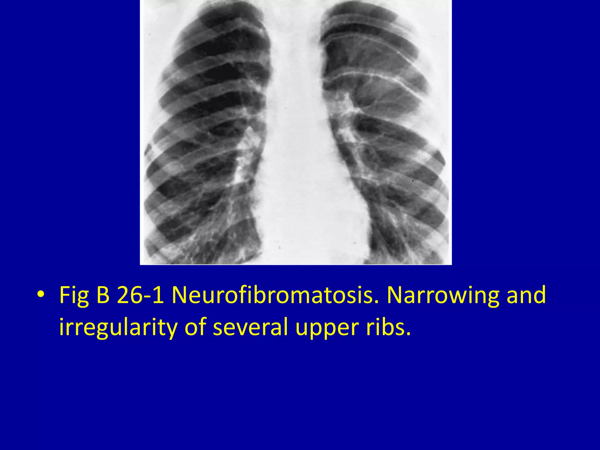 26 resorption or notching of superior rib margins | PPTX | Death ...