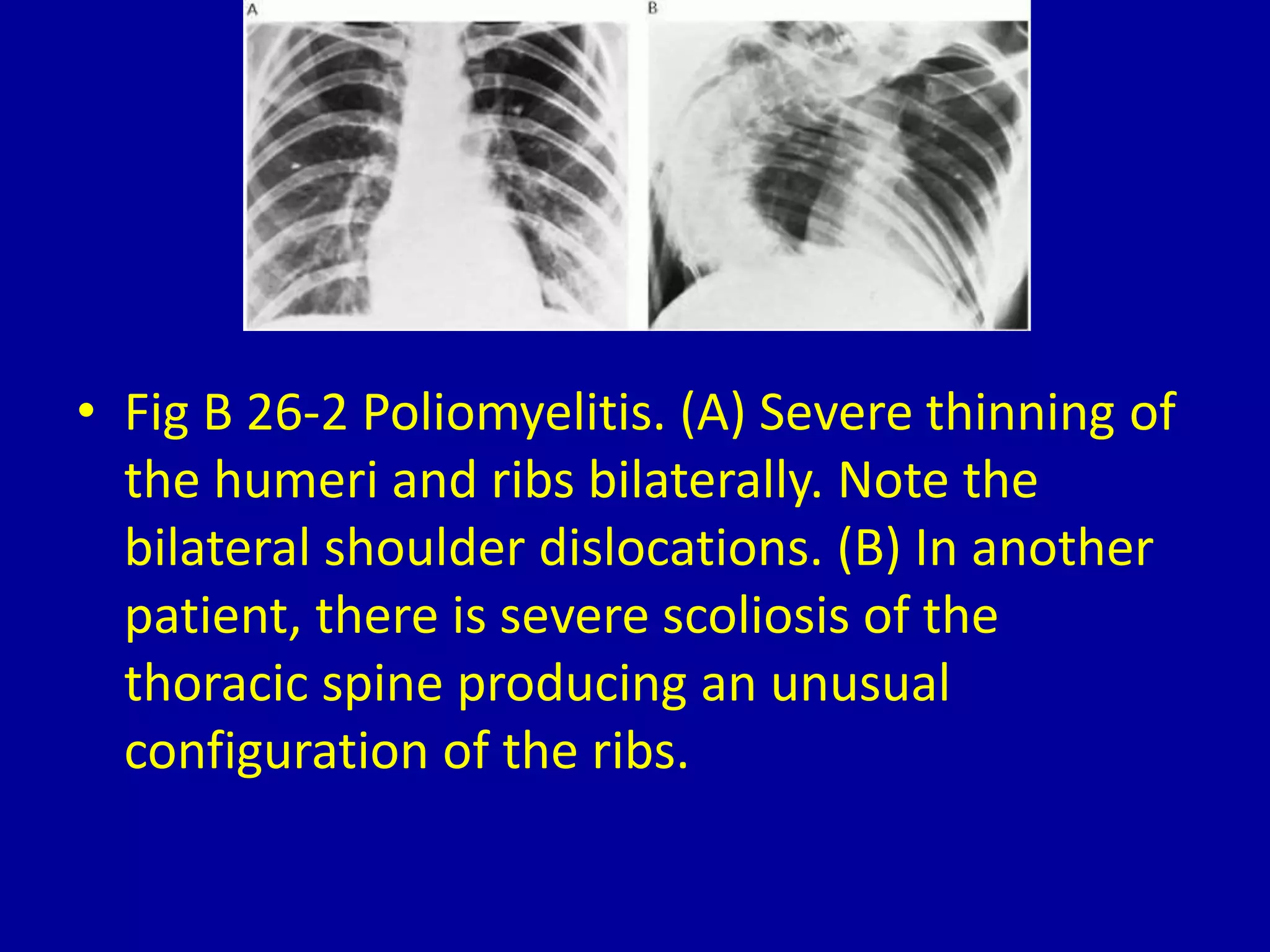 26 resorption or notching of superior rib margins | PPTX | Death ...