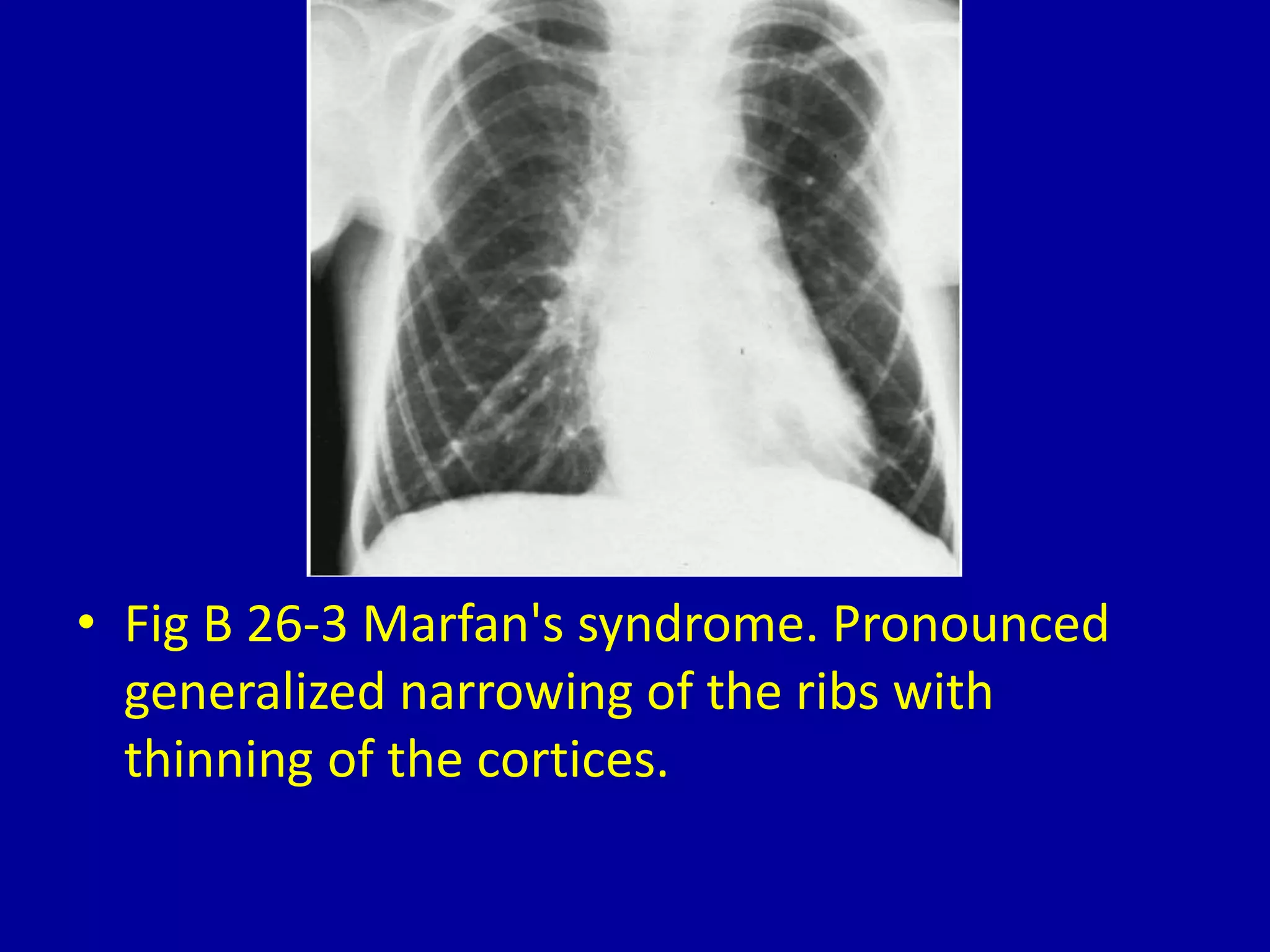 26 resorption or notching of superior rib margins | PPTX | Death ...
