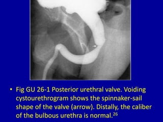 26 urinary tract obstruction below the bladder in | PPTX