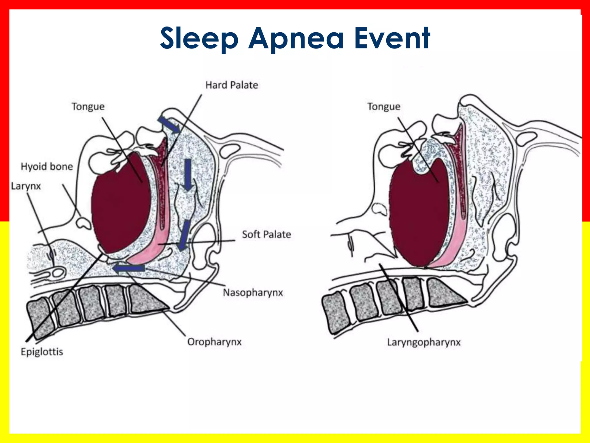 Obstructive Sleep Apnea Diagnostic Considerations | PPTX
