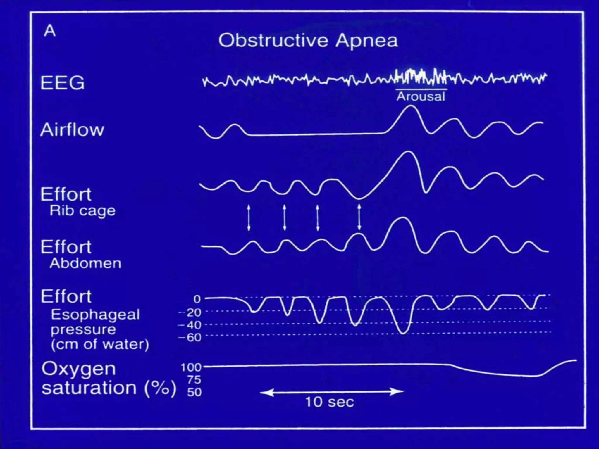 Obstructive Sleep Apnea Diagnostic Considerations | PPTX