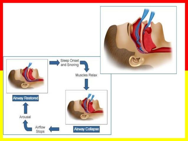 Obstructive Sleep Apnea Diagnostic Considerations | PPT