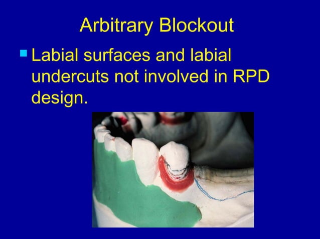 27. rpd lab procedures | PPT | Dental Health | Diseases and Conditions