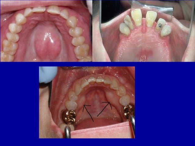 27. rpd lab procedures | PPT | Dental Health | Diseases and Conditions