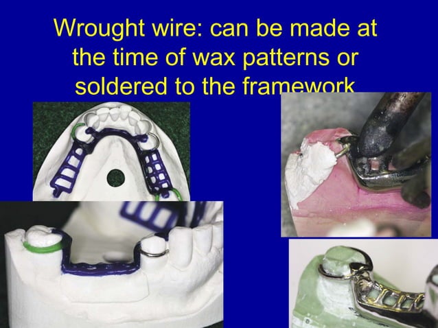 27. rpd lab procedures | PPT | Dental Health | Diseases and Conditions