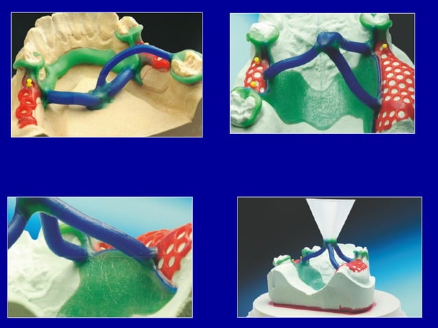 27. rpd lab procedures | PPT | Dental Health | Diseases and Conditions