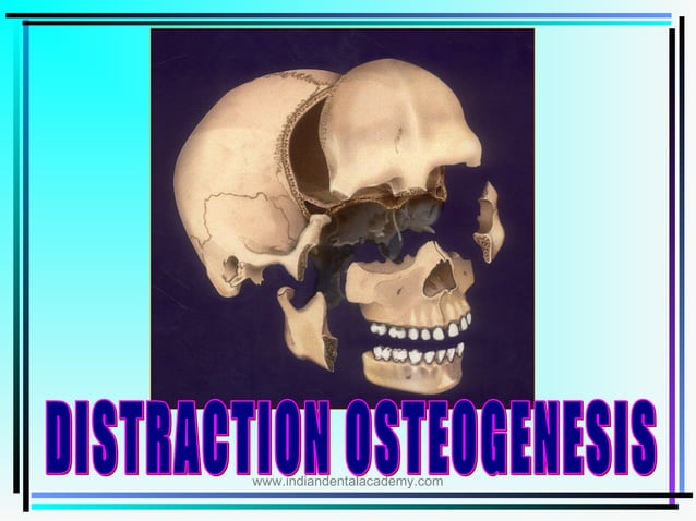 Distraction osteogenesis | PPT