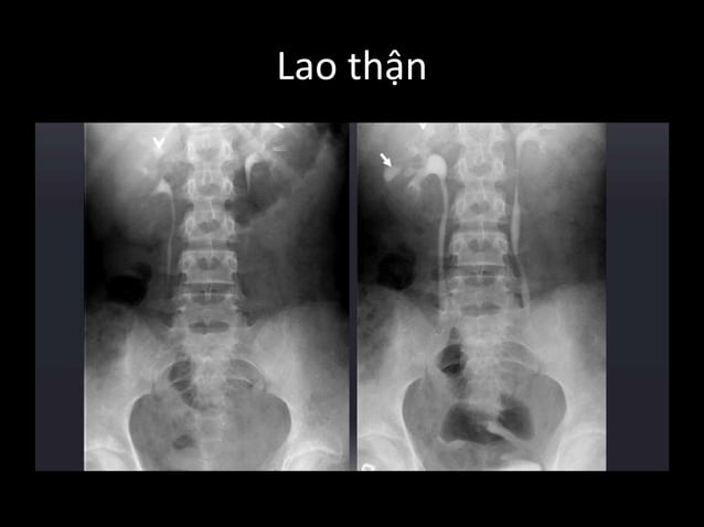 CLVT scanner Bệnh lý hệ tiết niệu | PPTX