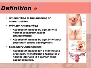 Amenorrhea