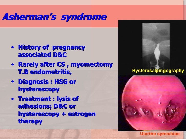 Asherman Syndrome